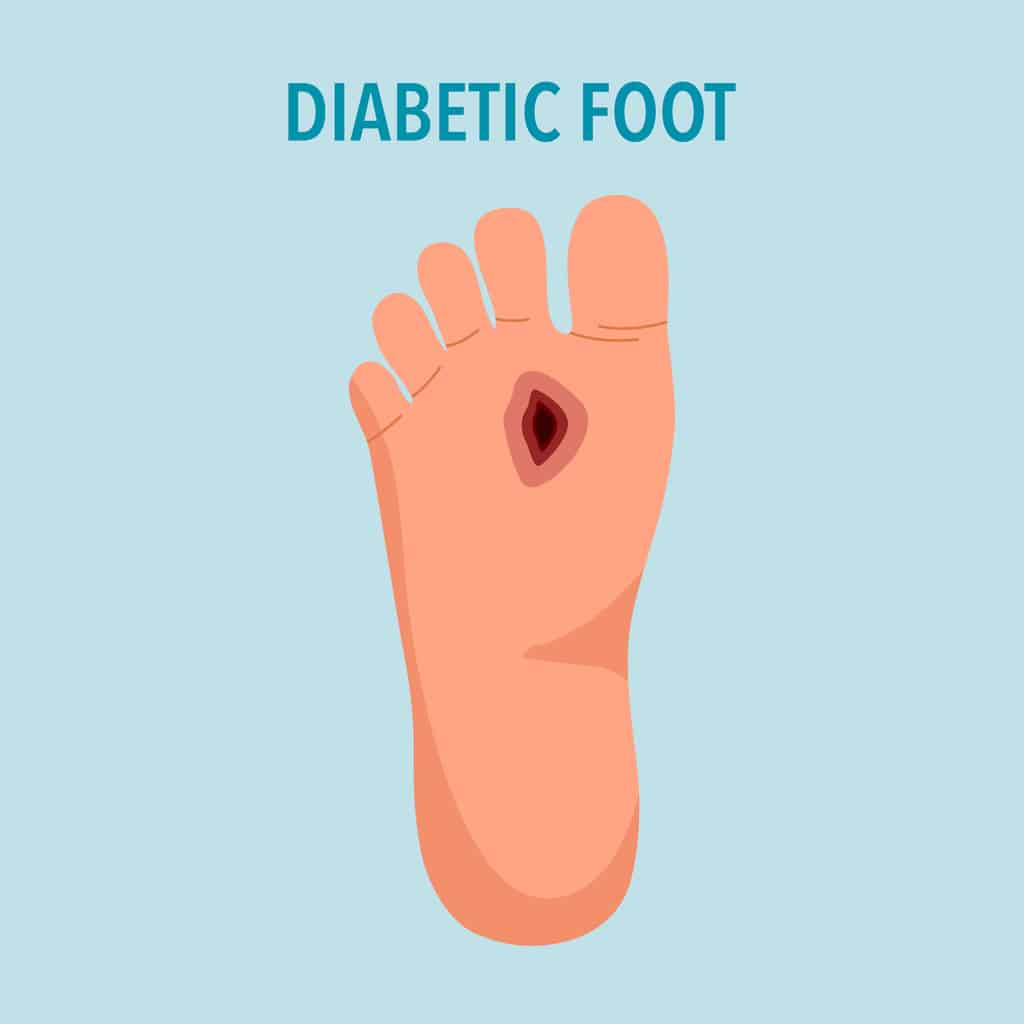 Diabetic Feet: Causes, Symptoms, and Treatment Options | The Bone ...