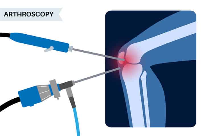 How Does Arthroscopic Knee Surgery Work? | The Bone & Joint Center